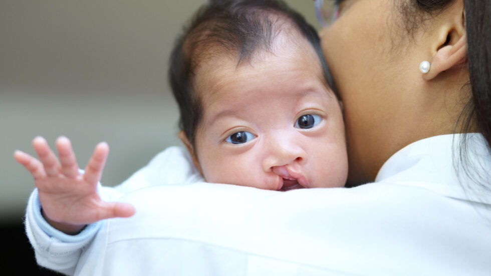 Children's Hypodontia Treatment Singapore | TEETH Paediatric
