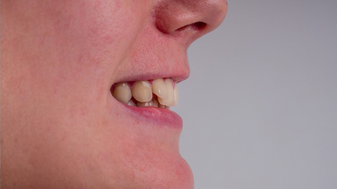 Crooked Teeth Treatment Singapore | TEETH @ Tiong Bahru Dental Clinic ...