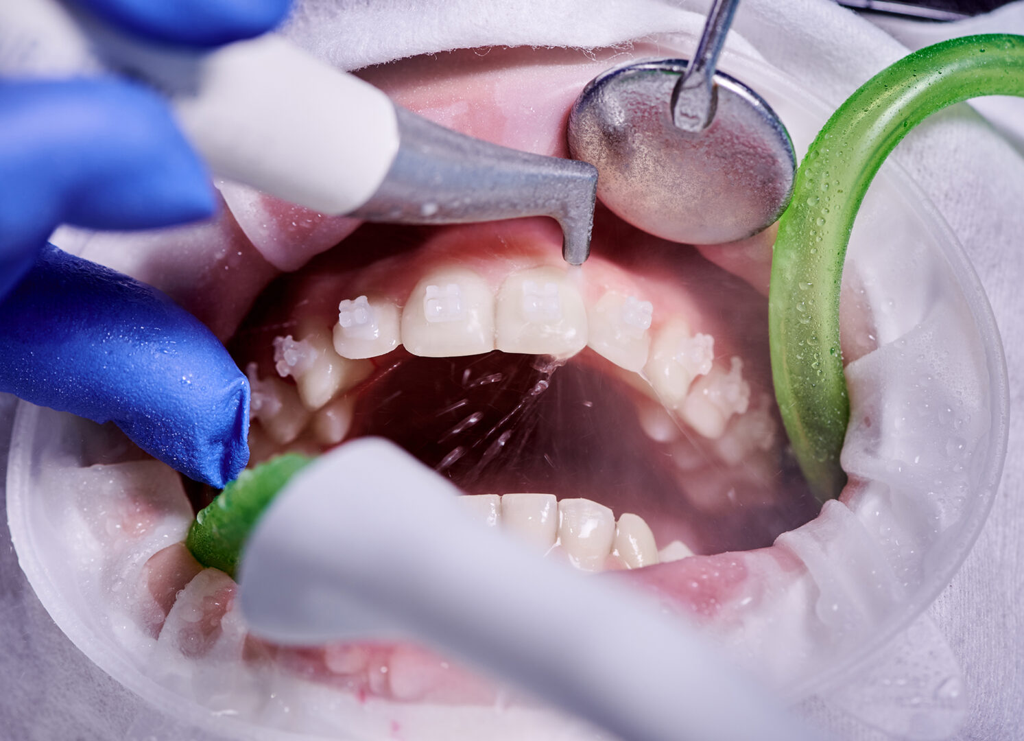 Dental Cleaning Procedure, Benefits, and Costs in Singapore