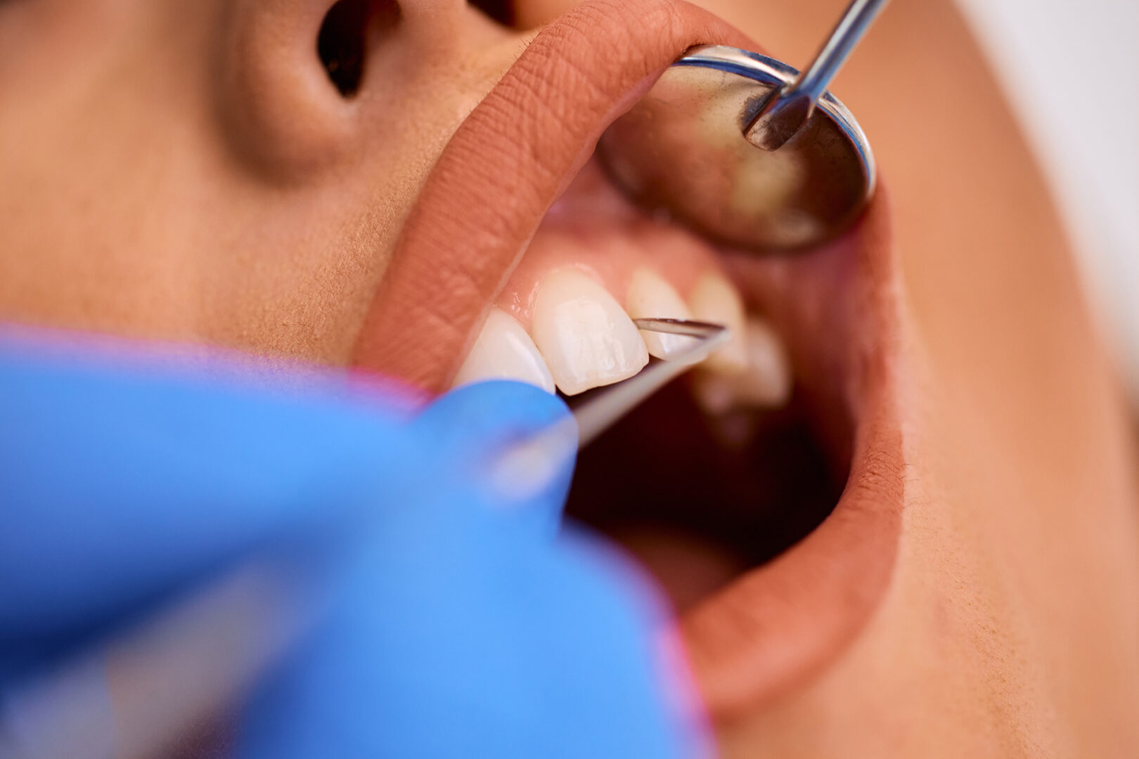 How Do You Treat a Gum Infection | Gum Disease Infection