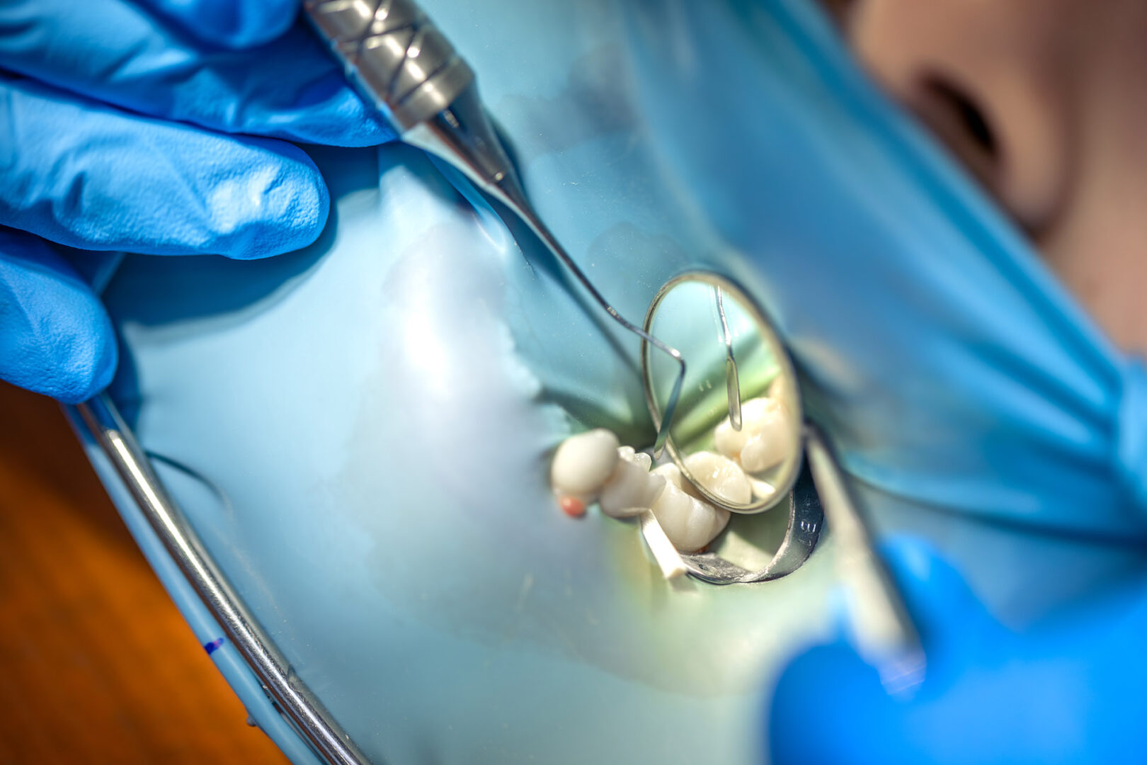 Molar Tooth Extraction: Procedure, Aftercare and Cost in Singapore