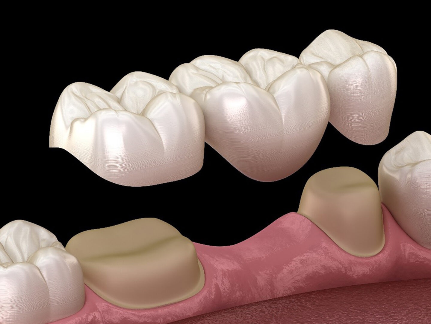 Tooth Bridges Procedure, Benefits and Cost in Singapore
