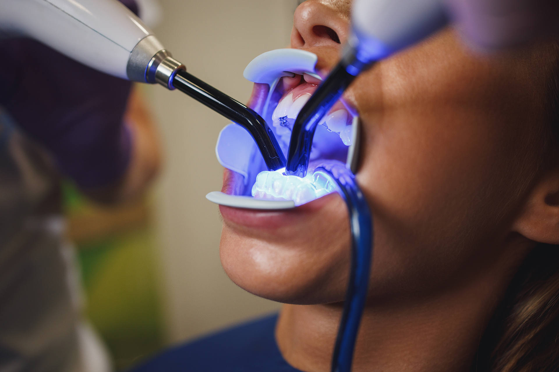 Composite Bonding: Procedure, Benefits and Cost in Singapore