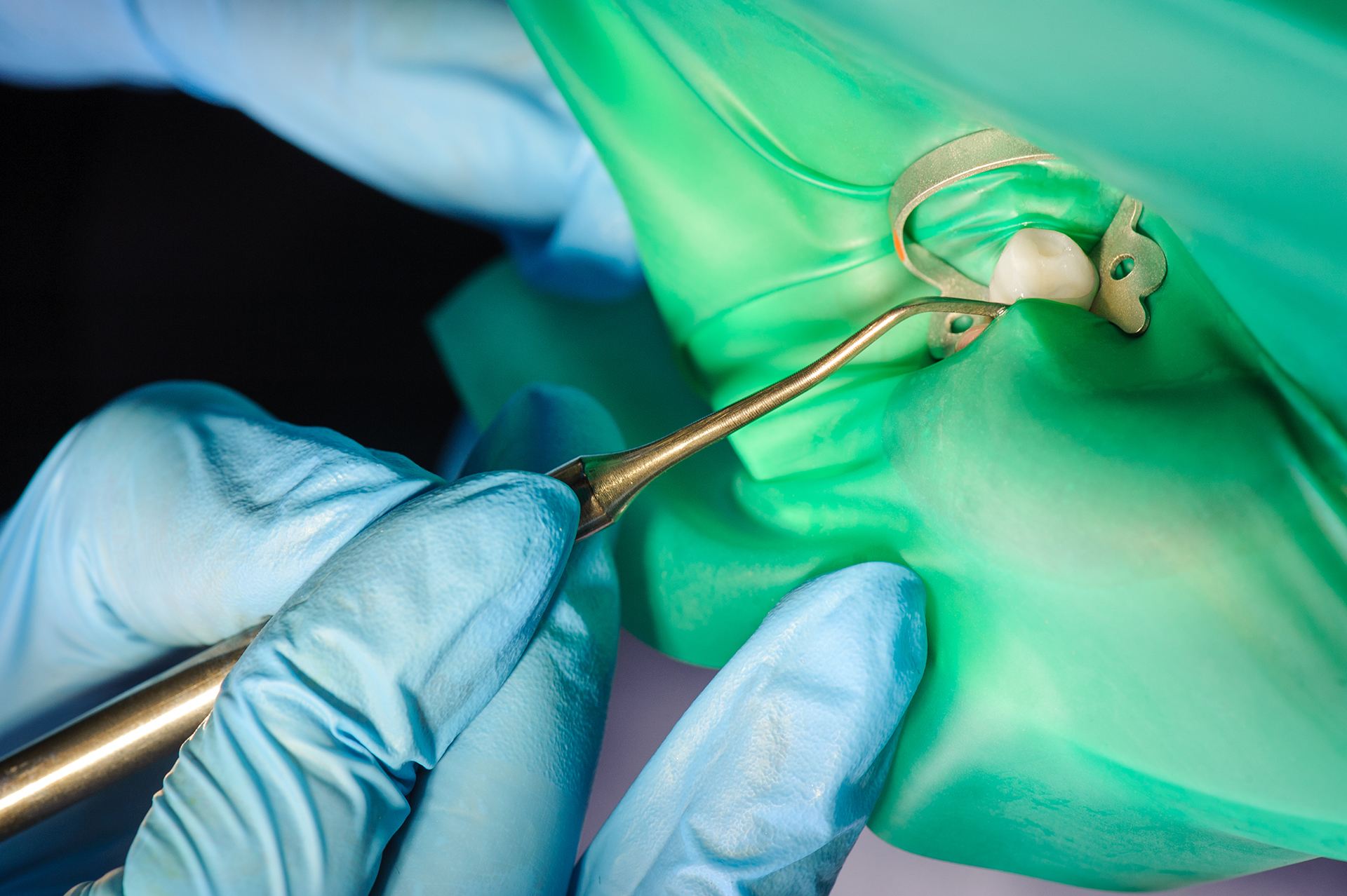 Wisdom Tooth Decay Singapore: Symptoms, Causes and Treatment